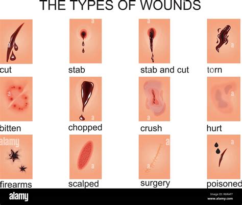 Types Of Open Wounds
