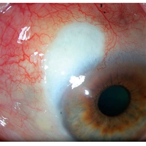 Necrotizing Scleritis Without Inflammation Or Scleromalacia Perforans Download Scientific