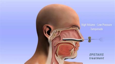 Epistaxis Treatment 3d Youtube