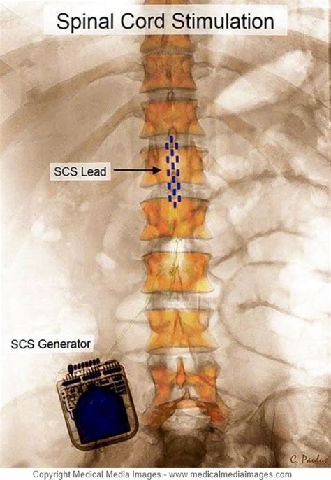23 Best Images About Spinal Cord Stimulator On Pinterest Spinal Cord