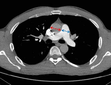 Ct Anatomy Of Pulmonary Artery At Emma Sparks Blog
