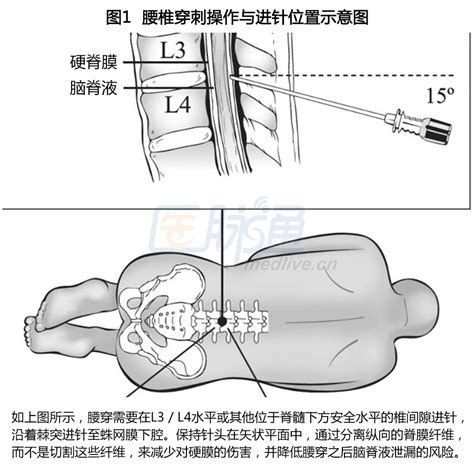 腰椎麻醉硬膜外穿刺 伤感说说吧