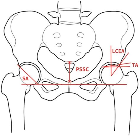 Differences Of Anteroposterior Pelvic Radiographs Between Supine Position And Standing Position