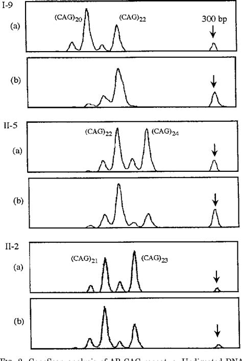 Figure 1 From Detection Of Skewed X Inactivation In Two Female Carriers Of Vasopressin Type 2