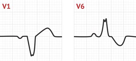 Left Bundle Branch Block Ecg Interpretation Medschool