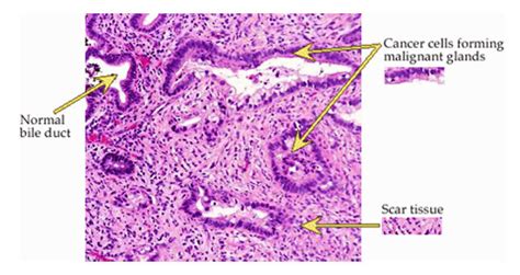 Bile Duct Histology Bile Duct Adenoma Basicmedical Key
