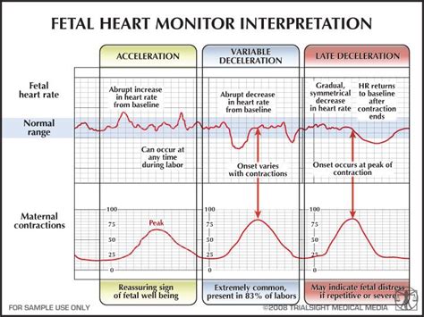Fetal Heart Monitor Interpretation