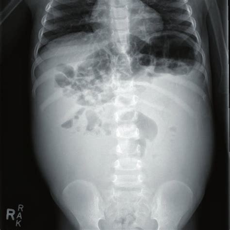 Reverse Axillary Mapping Using Lymphazurin Injection Download Scientific Diagram