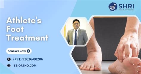 Athletes Foot Treatment Shri Bone And Joint Clinic Shri Bone And Joint