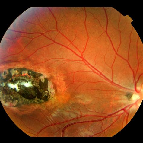 Toxoplasmosis Retina