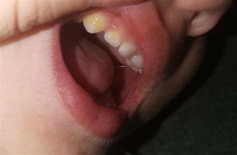 Mléčné Zuby Je To Kaz Modrý Koník