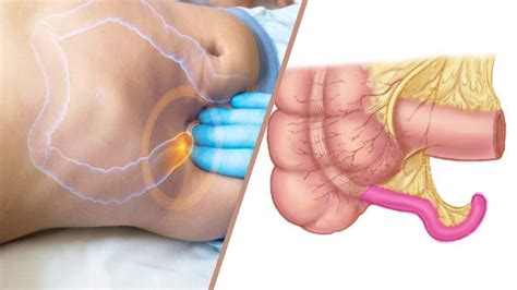 What Does The Appendix Do SurgMedia