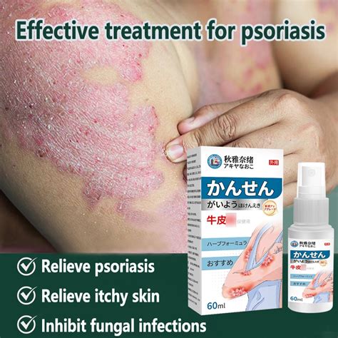 Psoriasis Spray Eczema 60ml Dermatitis Anti Fungal Spray Anti Itch Say Bye To Tinea Pedis