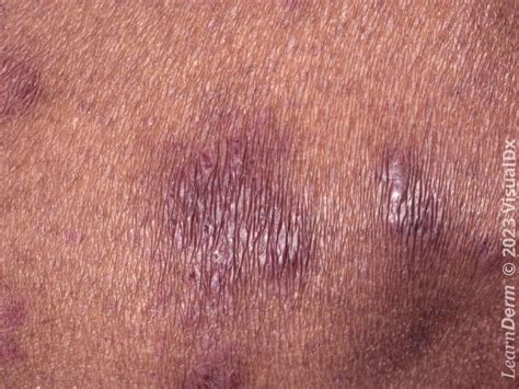 Palpable Purpura Learnderm