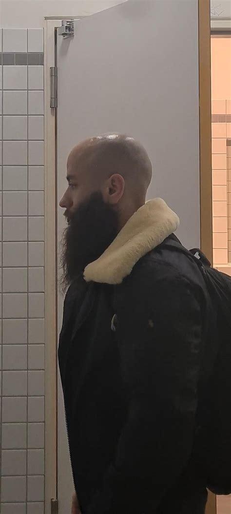 Is My Maxilla Flat Is It Average Recessed 🤔 Do I Need Surgery R Orthotropics