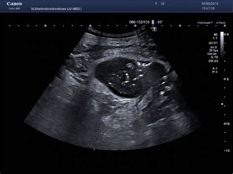 Classification Of Acute Appendicitis Caa Type 3b On Ultrasound