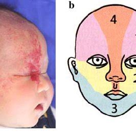 Pdf Update On Hemangiomas And Vascular Malformations Of The Head And Neck