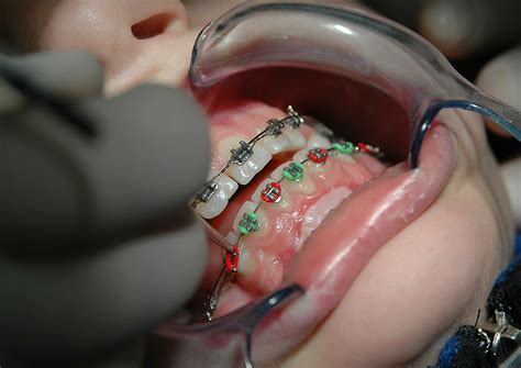 Jangan Asal Beli Behel Murah Bikin Salah Kaprah