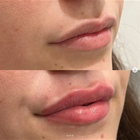 Lip Fillers Before And After Real Results And What To Expect