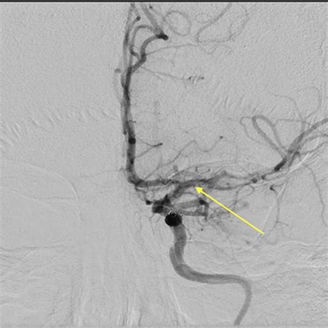 Cerebral Angiogram Showing Tici 3 Reperfusion Post‐thrombectomy 1 9 17 Download Scientific Diagram