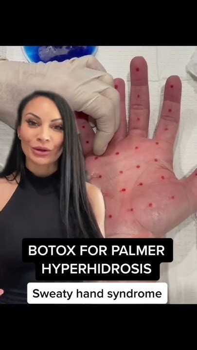 Palmer Hyperhidrosis Botox For Sweaty Hands Youtube
