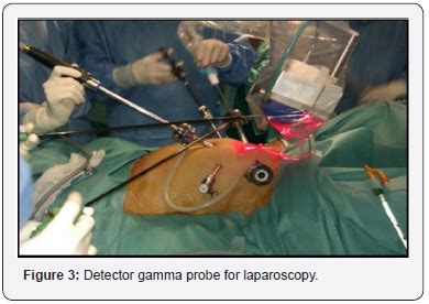 Sentinel Lymph Node Detection In Patients With Cervical Cancer Juniper Publishers
