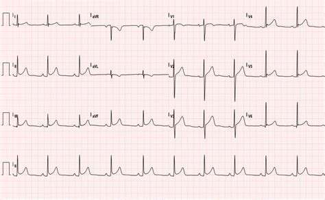 Acute Pericarditis Electrocardiogram Jetem