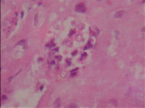 Isolated Cavitary Lung Disease In A Renal Allograft Recipient A Rare