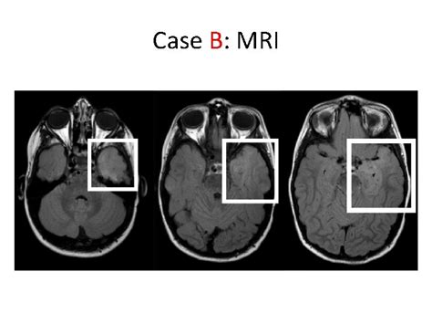 How Brain Somatic Mutations Lead To Epilepsy Dr