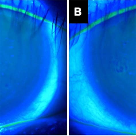 Diffuse Lamellar Keratitis After Diamond Burr Superficial Keratectomy Download Scientific