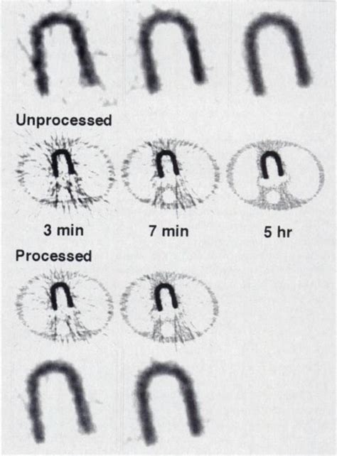 Measured Dashed Line And Estimated Solid Line Phantom Histograms Download Scientific