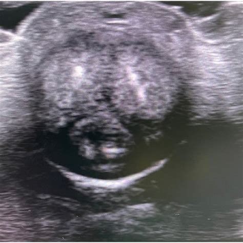 Penile Duplex Ultrasound Demonstrated Heavily Calcification Bilateral Download Scientific