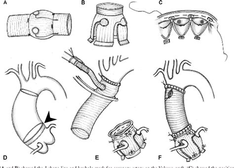 Figure 2 From Modified Sleeve Technique In Aortic Valve Sparing