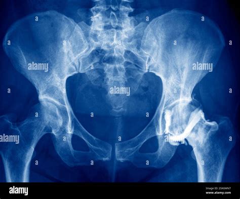Coloured X Ray Arthrogram Front View Of A Healthy Hip Joint At Right Of The Pelvis In A 55
