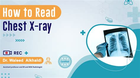 How To Read Chest X Ray Learn Curve