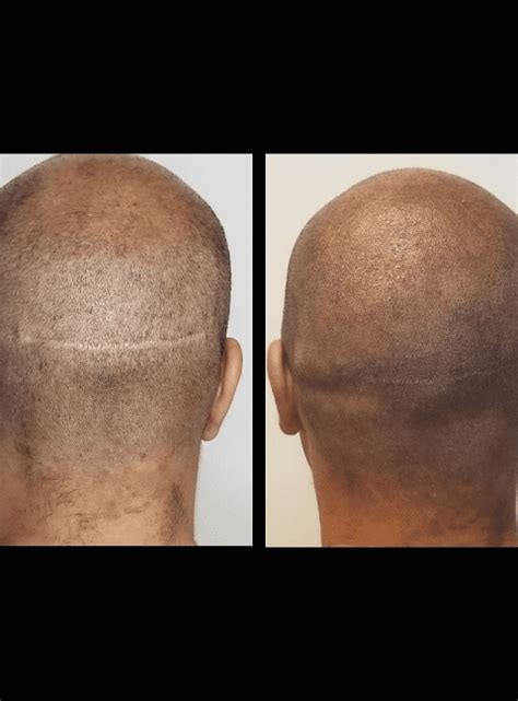 Smp Scalp Camouflage Atlanta Look Natural Look Natural