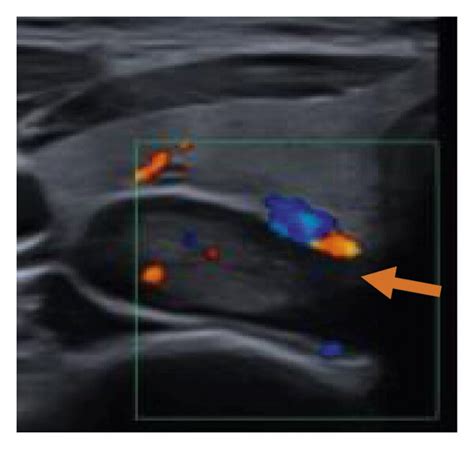 The Ultrasound From The Patient With A Giant Parathyroid Adenoma