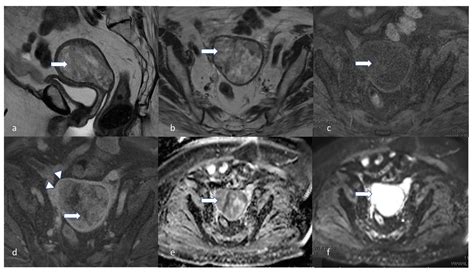 Endometrial Cancer 2023 Revised Figo Staging System And The Role Of