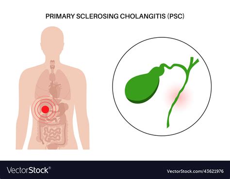 Primary Sclerosing Cholangitis Royalty Free Vector Image
