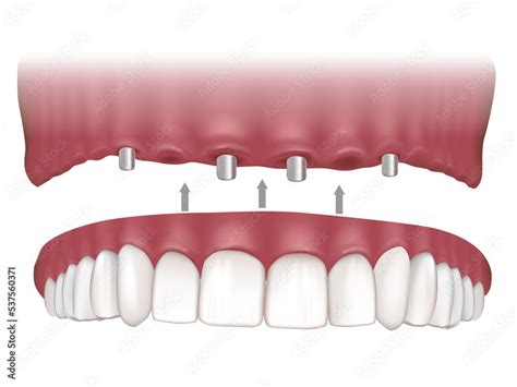Maxillary Implant Supported Fixed Prosthesis Maxillary Overdentures Supported By Four Implants