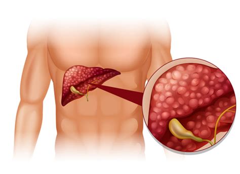 Cholangiocarcinoma Understanding Symptoms And Treatment Options