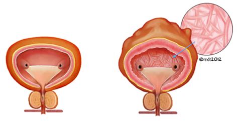 Figure 2 Comparison Of A Normal Bladder Left And A Trabeculated And