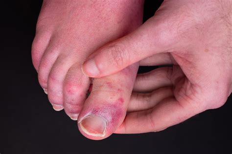Chilblains Symptoms Causes And Treatments Profoot