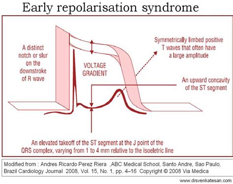 Emerging Truths About Early Repolarisation Syndrome Drsvenkatesan Md