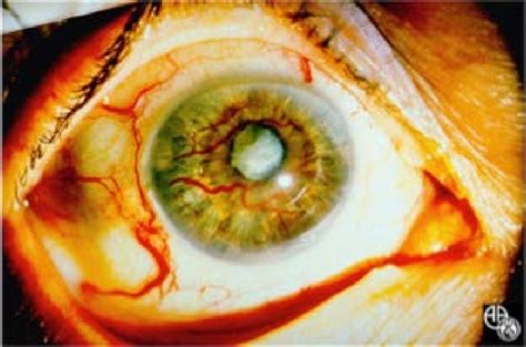 Neovascularization Of The Iris Nvi Corresponding To Advanced Retinal Download Scientific