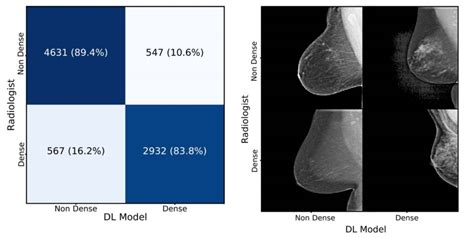 Deep Learning Algorithm Identifies Dense Tissue In Mammograms Physics World
