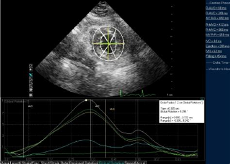 Rotation By Speckle Tracking Echocardiography The Curves Represents