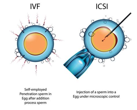Ivf Vs Icsi Which Is Better For Infertility Treatment Ilajak Medical