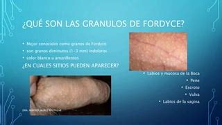 Granulos De Fordyce Pptx