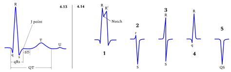 Qrs Complex Skillstat